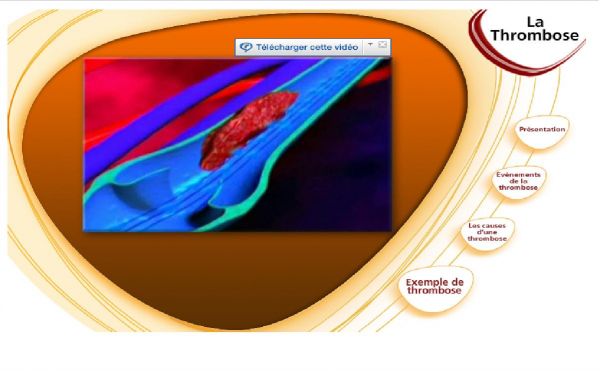 La Maladie Thromboembolique Veineuse