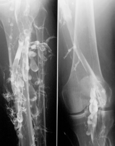 La Maladie Thromboembolique Veineuse